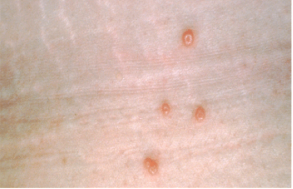 Molluscum Contagiosum