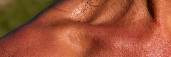 Sun-Damaged Skin? How to Repair and Rejuvenate After Summer - Camelback ...